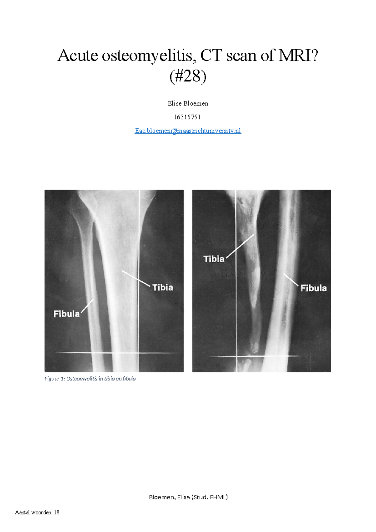 Acute osteomyelitis, CT scan of MRI? - Acute osteomyelitis, CT scan of ...