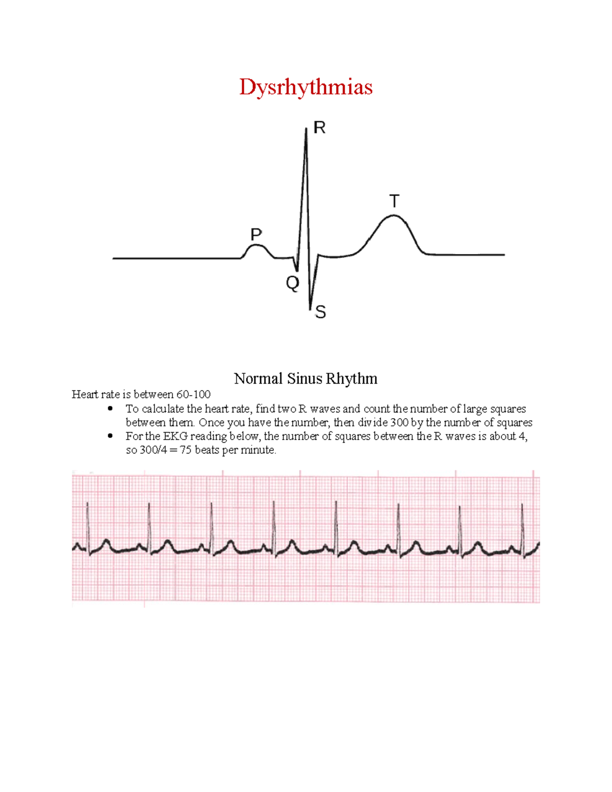 Dysrhythmias (Notes) - Dysrhythmias Normal Sinus Rhythm Heart rate is ...