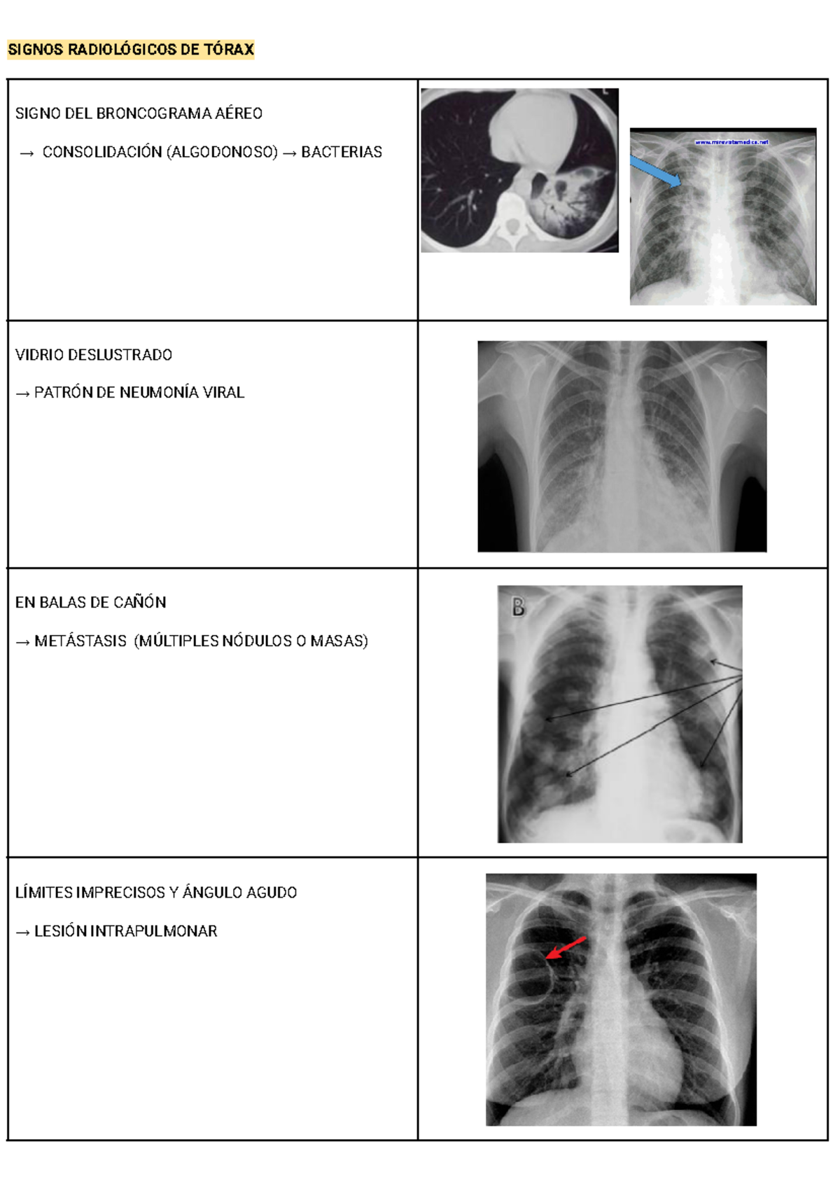 Repaso Primer Parcial GUIA MEX - SIGNOS RADIOLÓGICOS DE TÓRAX SIGNO DEL ...