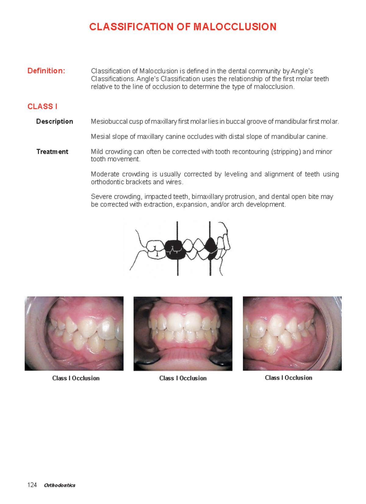 IHCD 13 IHCD 124 Orthodontics ClaSSIfICaTION Of MalOCCluSION ClaSS