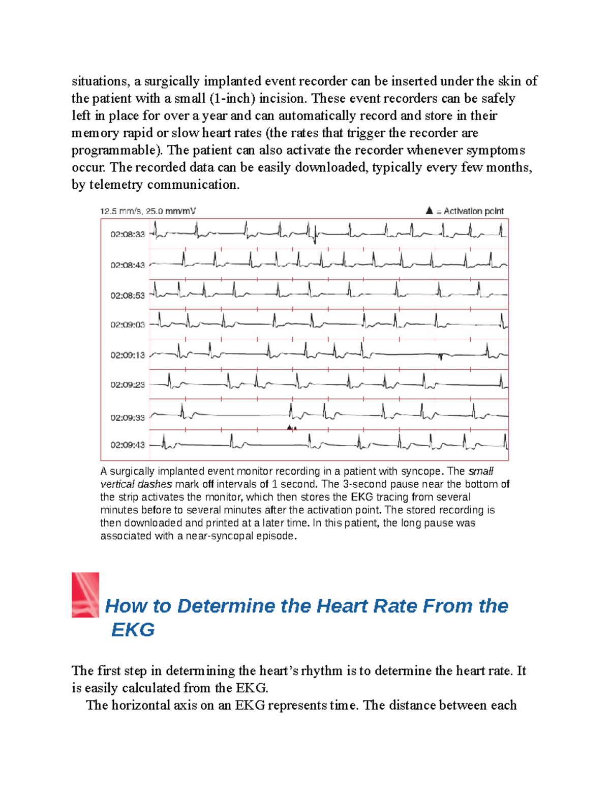 The only EKG-42 - situations, a surgically implanted event recorder can be inserted under the ...