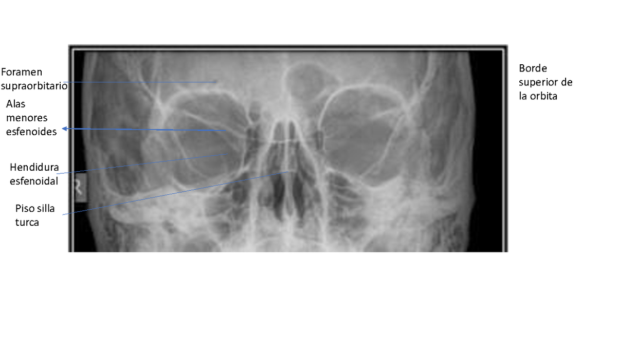 2 - anatomia radiologica rx orbita - anatomía radiológica - Foramen ...