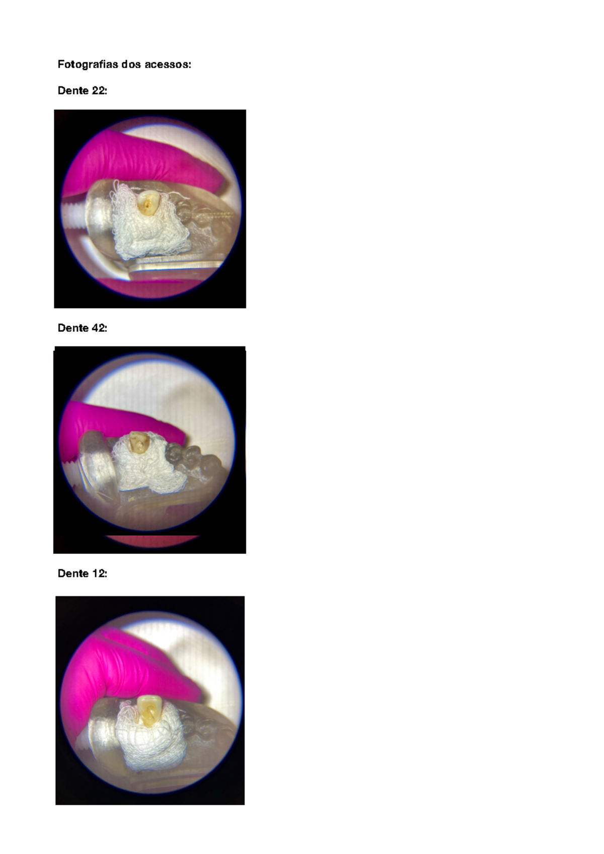 Endodontia - Imagens de canais - anatomia - Fotografias dos acessos ...