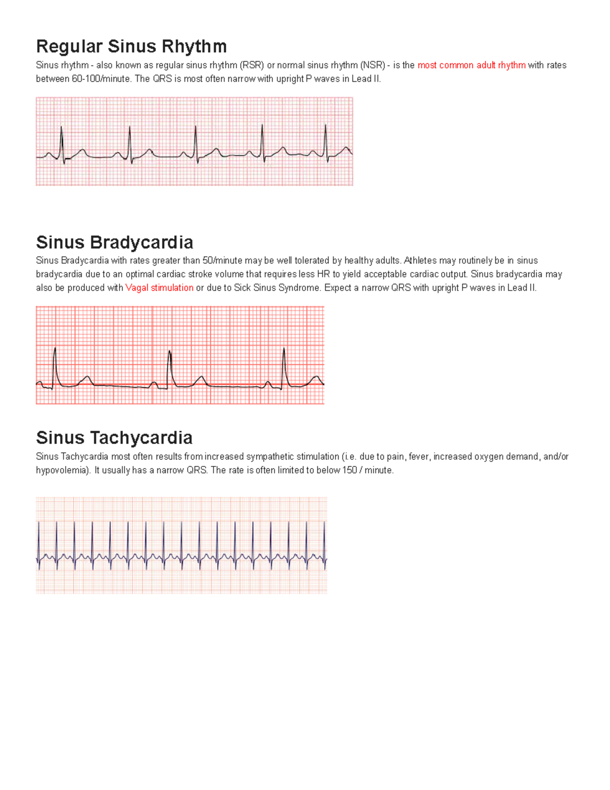 Heart rhythms - Regular Sinus Rhythm Sinus rhythm - also known as ...