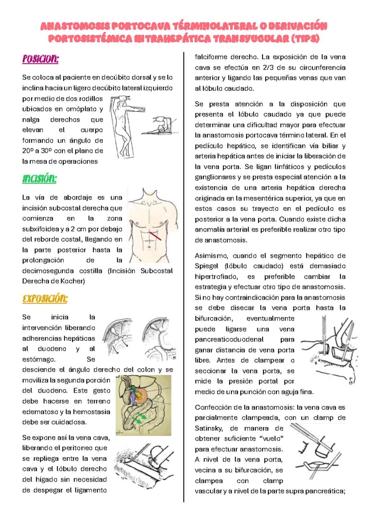 TQ Portocava - Resumen Técnica Quirúrgica II - ANASTOMOSIS PORTOCAVA ...
