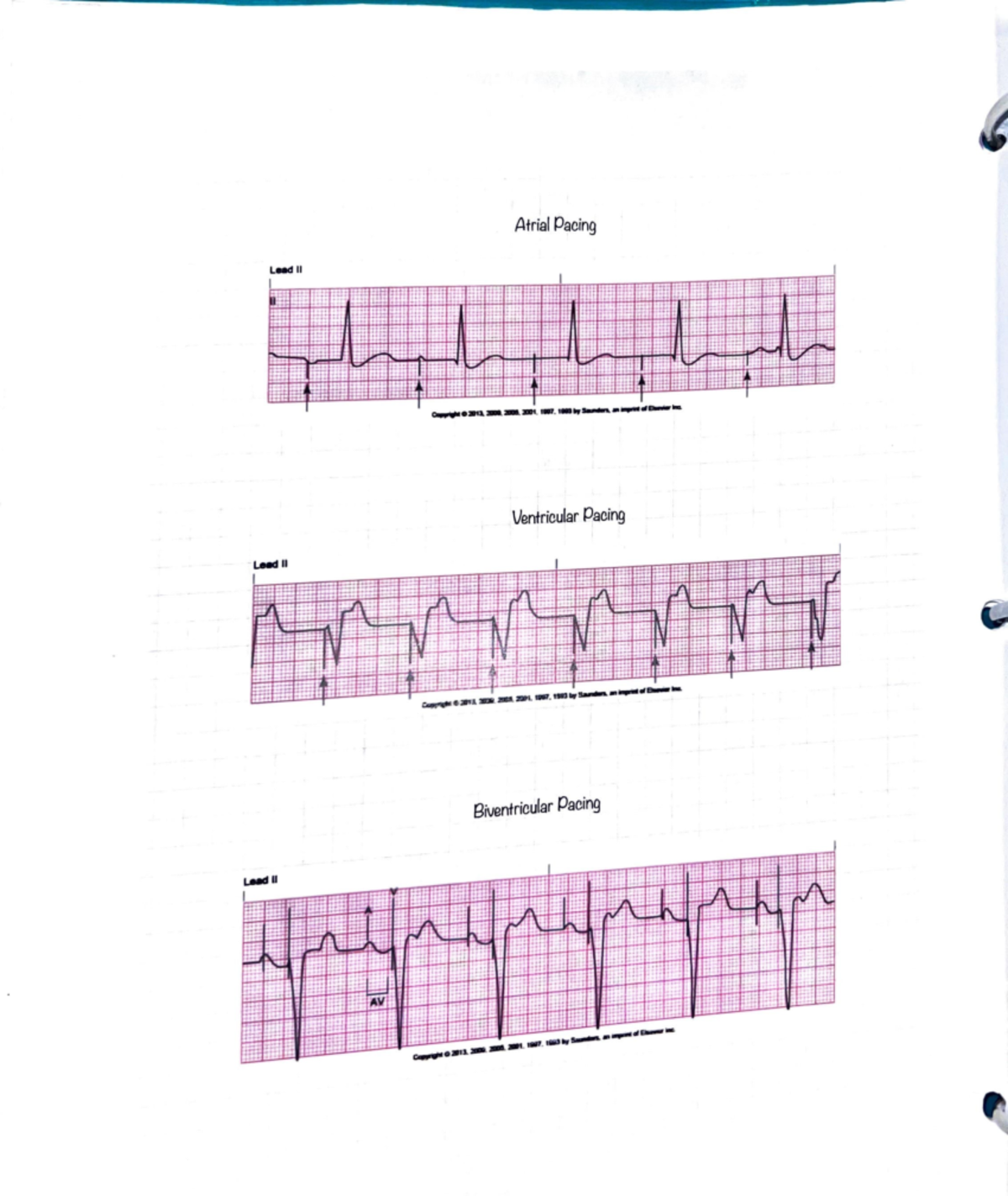 Pace Maker rhythms - Atrial Pacing LNdll Ventricular Pacing I I I I ...