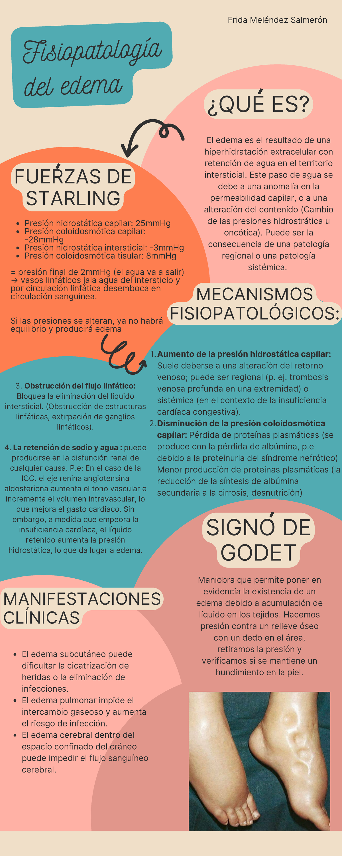 Edema - FUERZAS DE STARLING El edema es el resultado de una ...