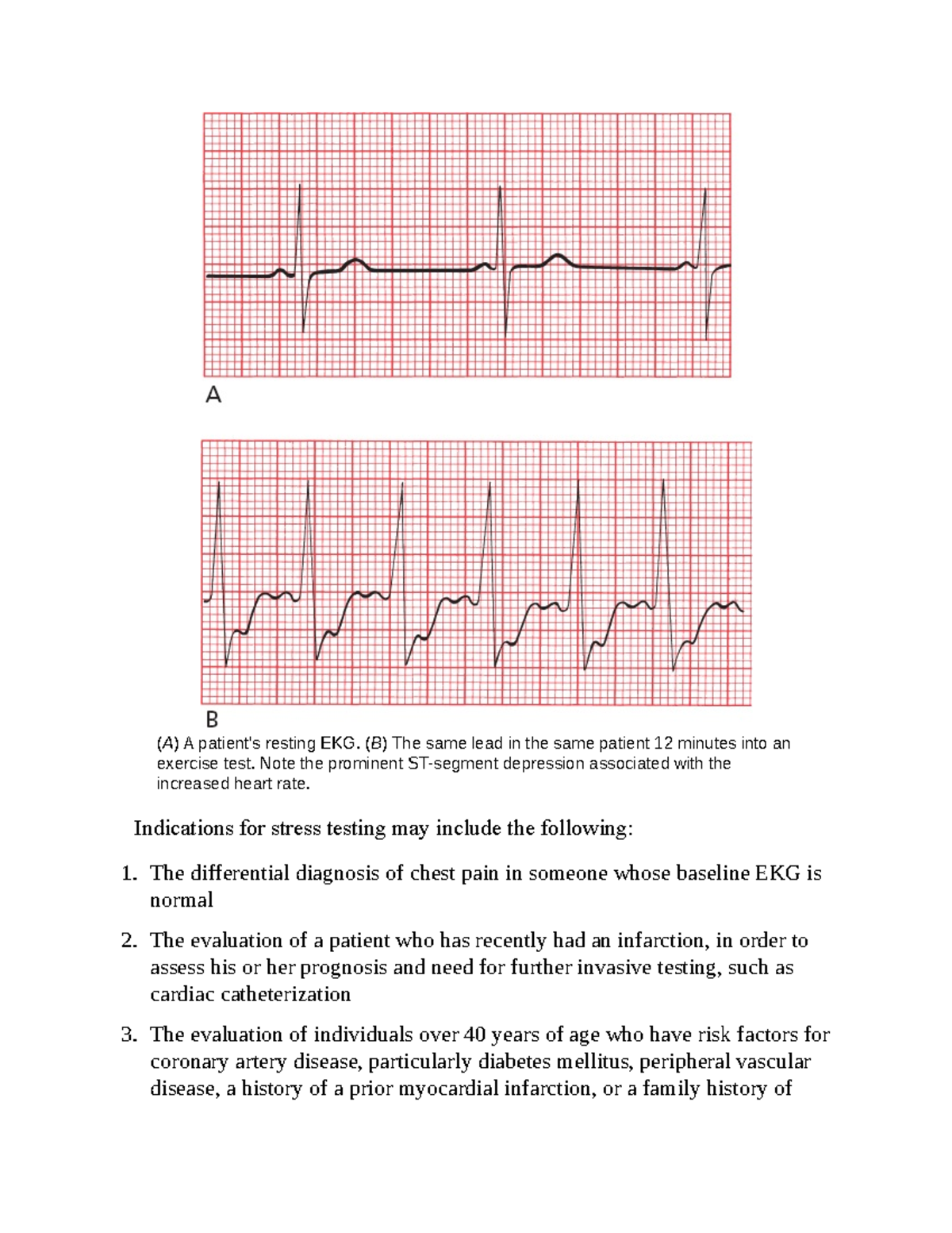 The only EKG-95 - The only EKG - (A) A patient’s resting EKG. (B) The ...