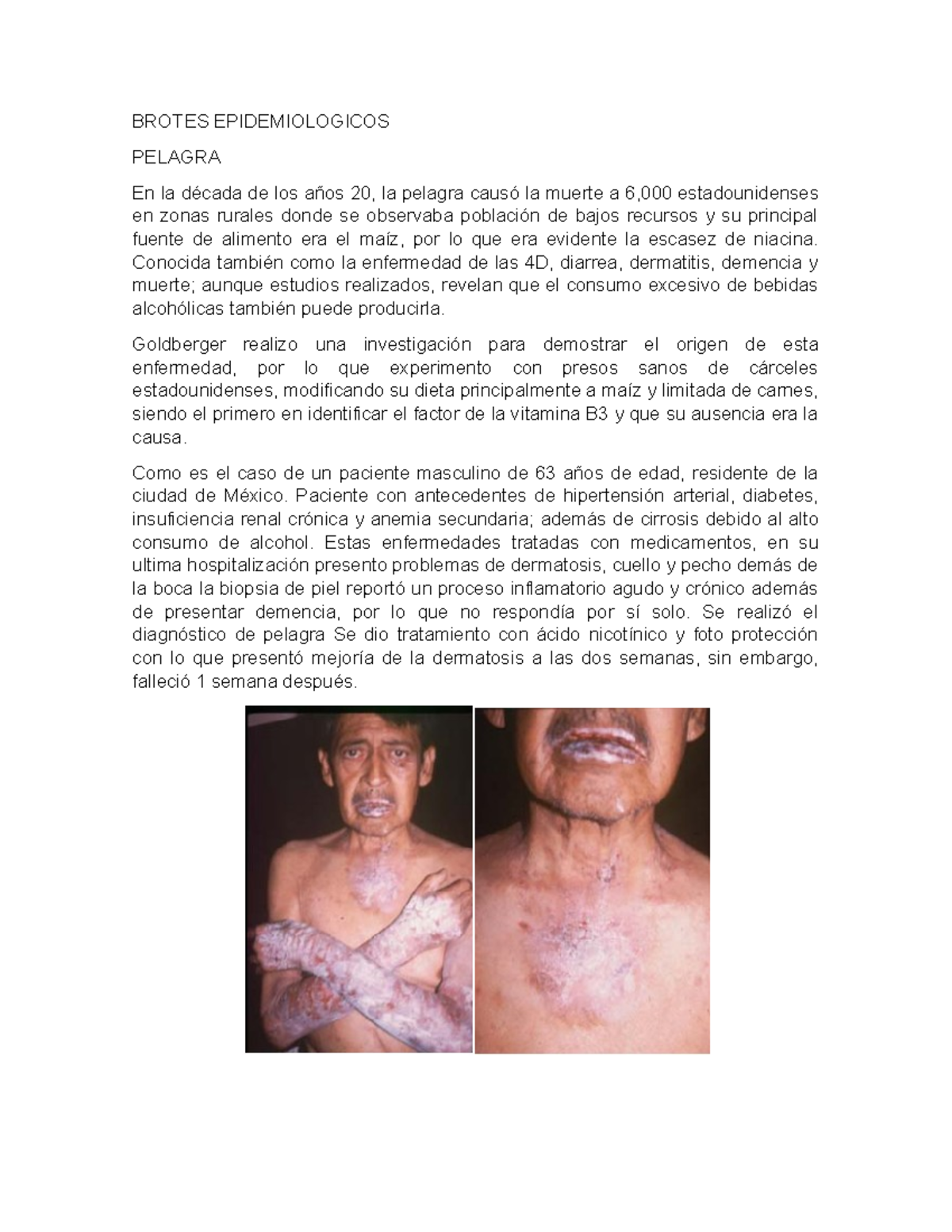 Brotes Epidemiologicos - BROTES EPIDEMIOLOGICOS PELAGRA En la década de ...