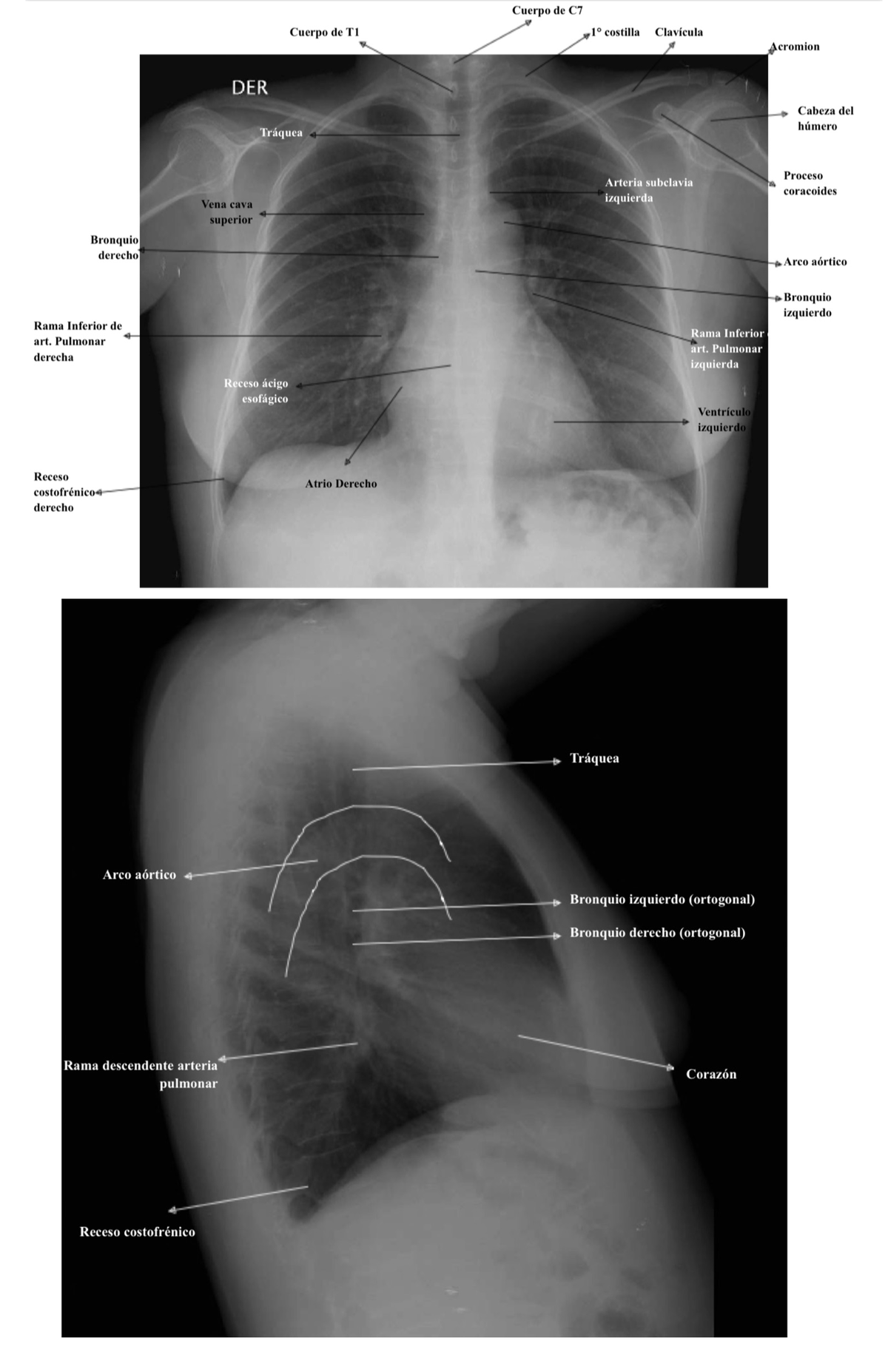 Tórax rx, TC - Cuerpo de C7 Cuerpo de T1 costilla Clavícula Acromion ...