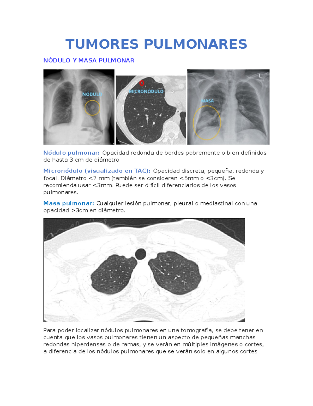 4) Tumores pulmonares - TUMORES PULMONARES NÓDULO Y MASA PULMONAR Nódulo pulmonar: Opacidad ...