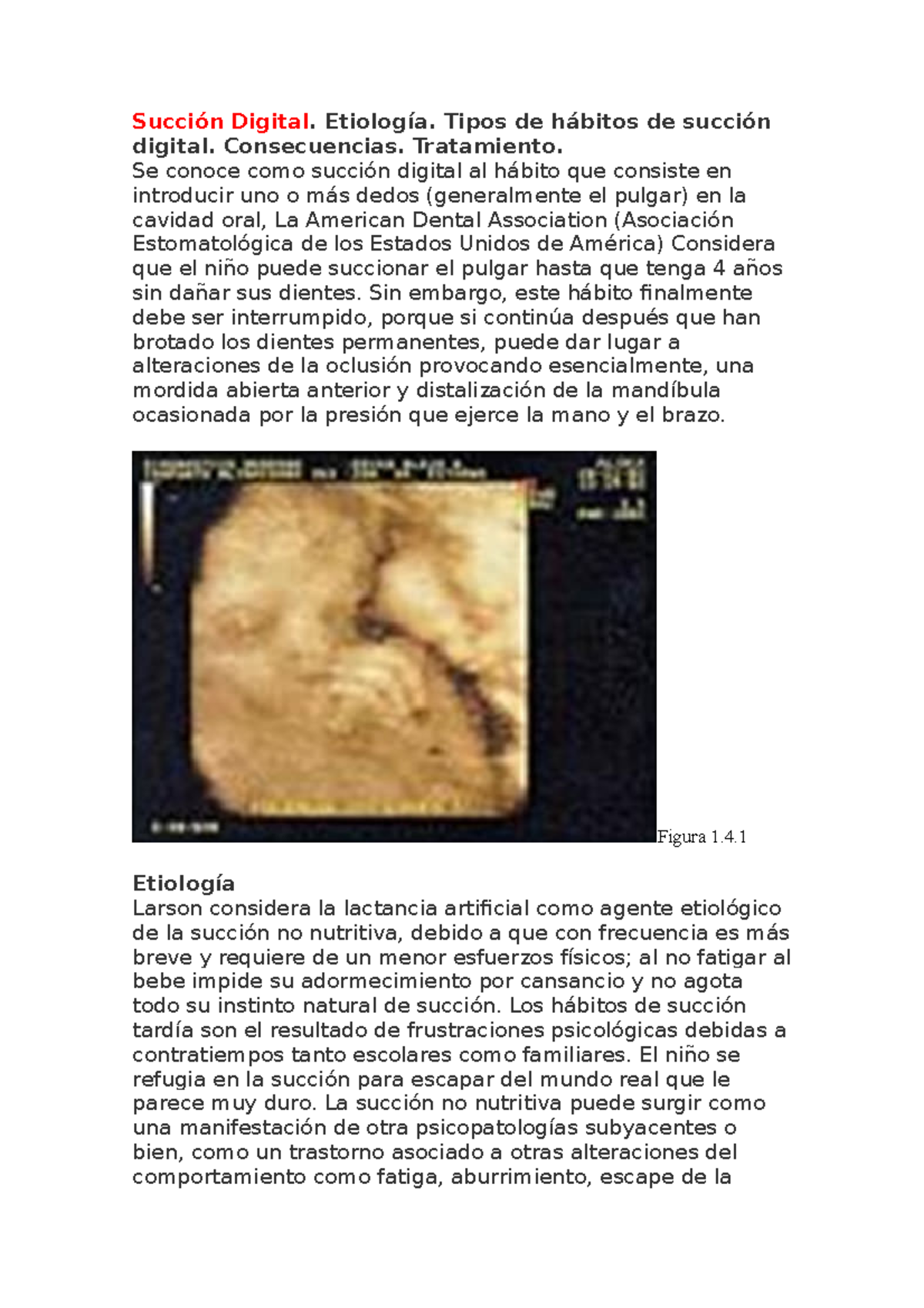 Temahabitosorales Isucciondededo - Succión Digital. Etiología. Tipos de ...