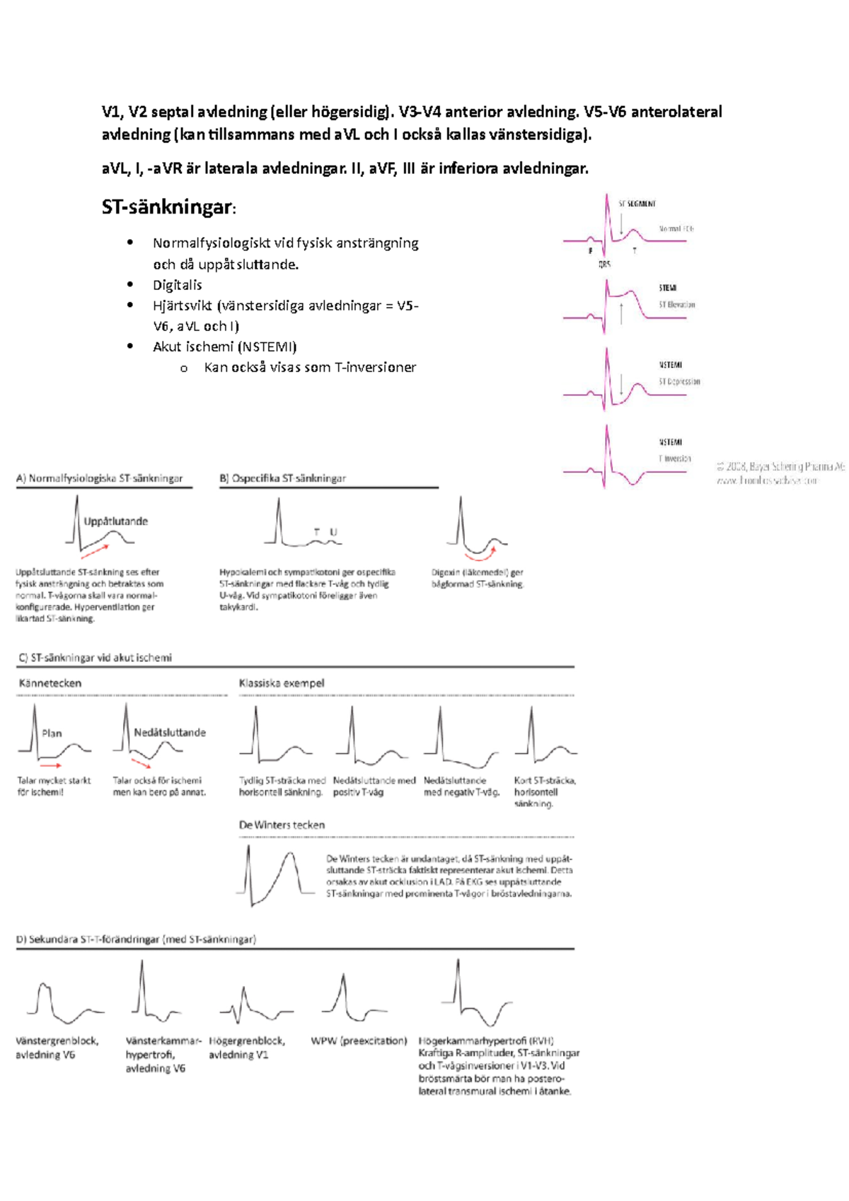 EKG kort - EKG, sammanfattning - V1, V2 septal avledning (eller ...