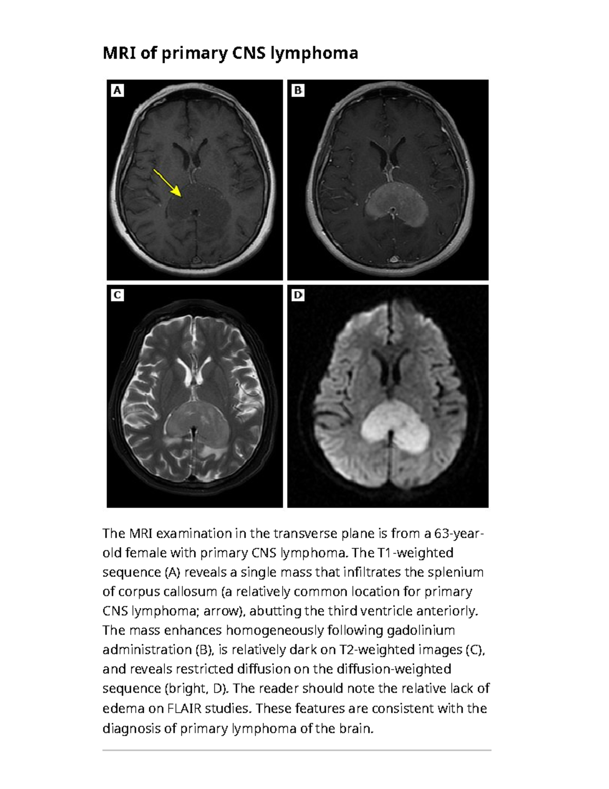 Default(35) - cns lymphoma - MRI of primary CNS lymphoma The MRI ...
