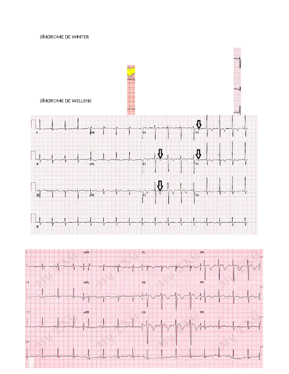 Electrocardiogramas Especiales - Cardiologia/Hematologia - SÍNDROME DE ...
