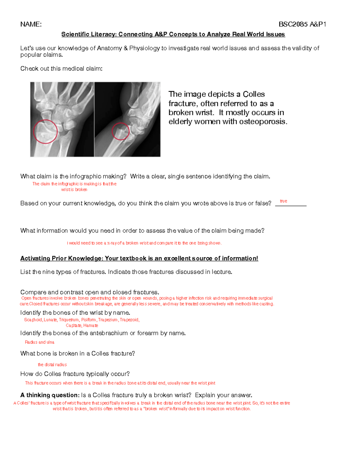 Colles Fractures(1).pdf finished - NAME: BSC2085 A&P Scientific ...