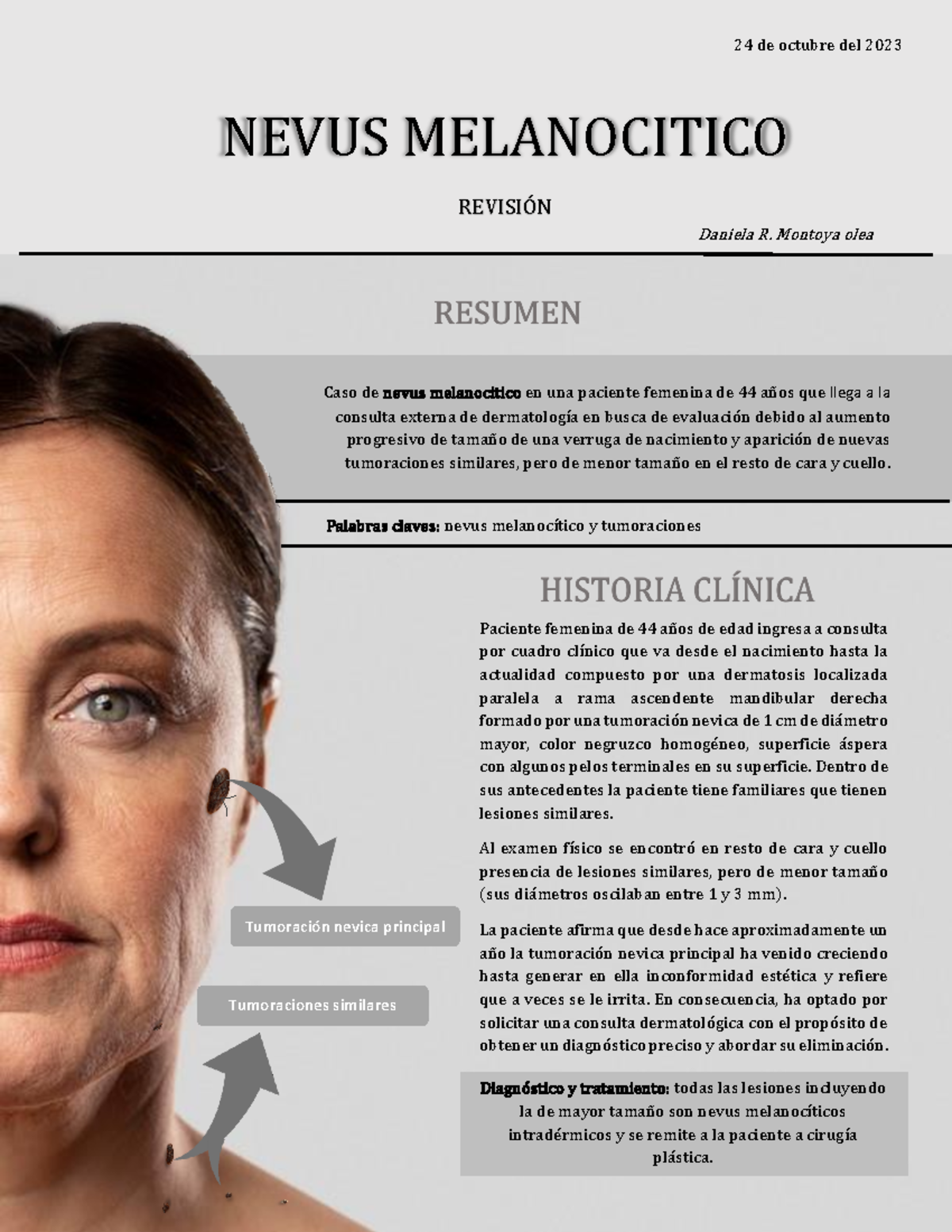 NEVO Melanocítico - NEVUS MELANOCITICO REVISIÓN 24 de octubre del 2023 ...