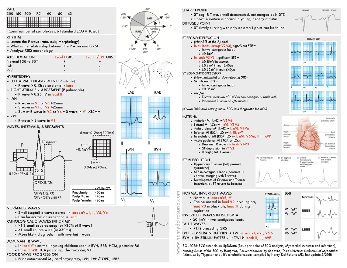 EKG cheat sheet - EKGs made easy - BBB V1: “M” V6: “W” V1: “W” V6: “M ...