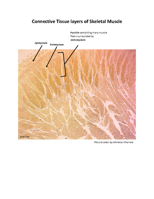 [Solved] Motor neuron disease MND is a set of neurodegenerative ...