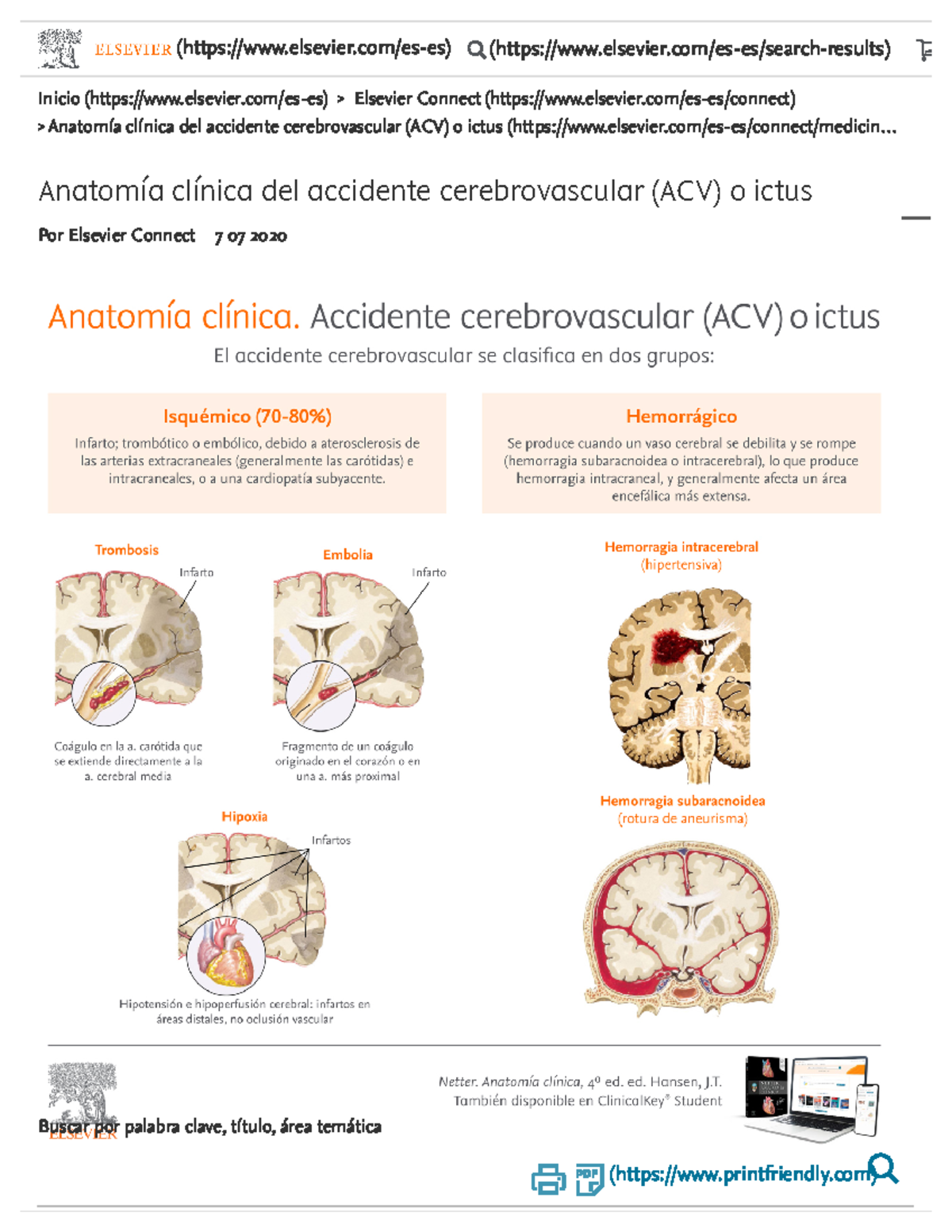 Anatomía clínica del accidente cerebrovascular (ACV) o ictus - Inicio ...