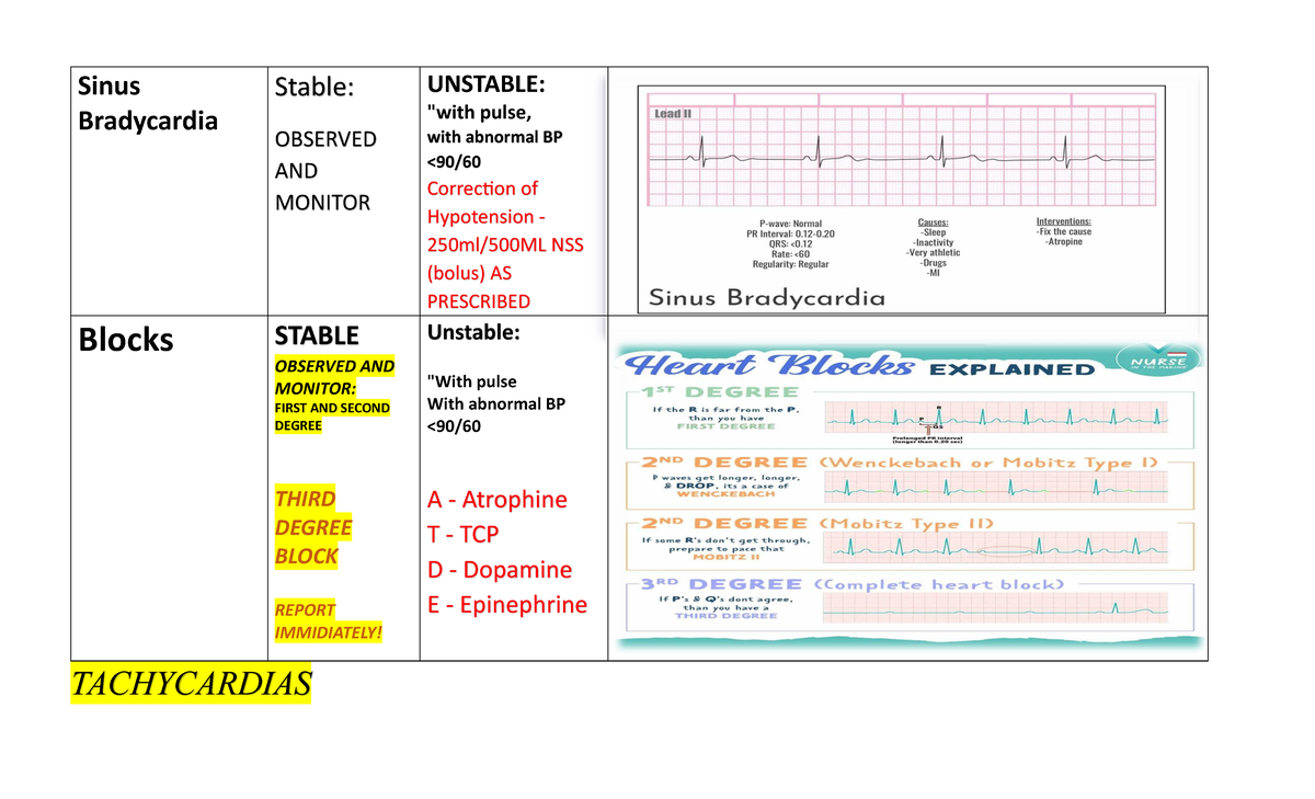 ECG - Strips - TACHYCARDIAS Sinus Bradycardia Stable: OBSERVED AND ...