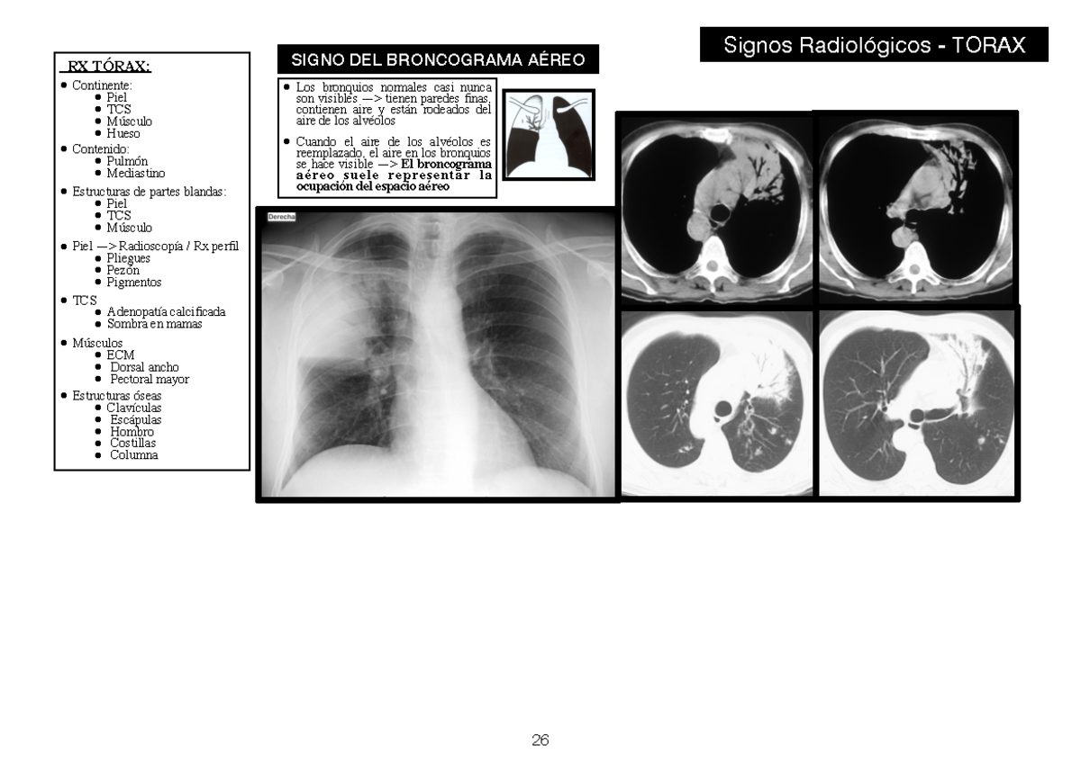 MAPS - Signos Radiologicos - Torax - Signos Radiológicos - TORAX RX ...