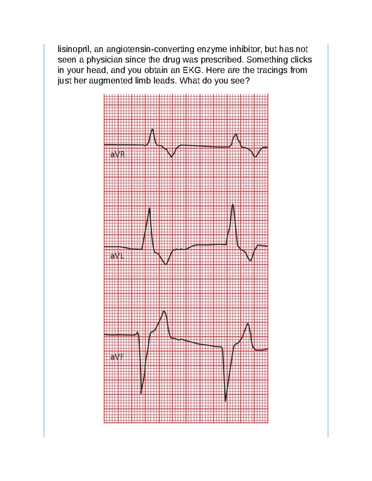 The only EKG-110 - The only EKG - lisinopril, an angiotensin-converting ...