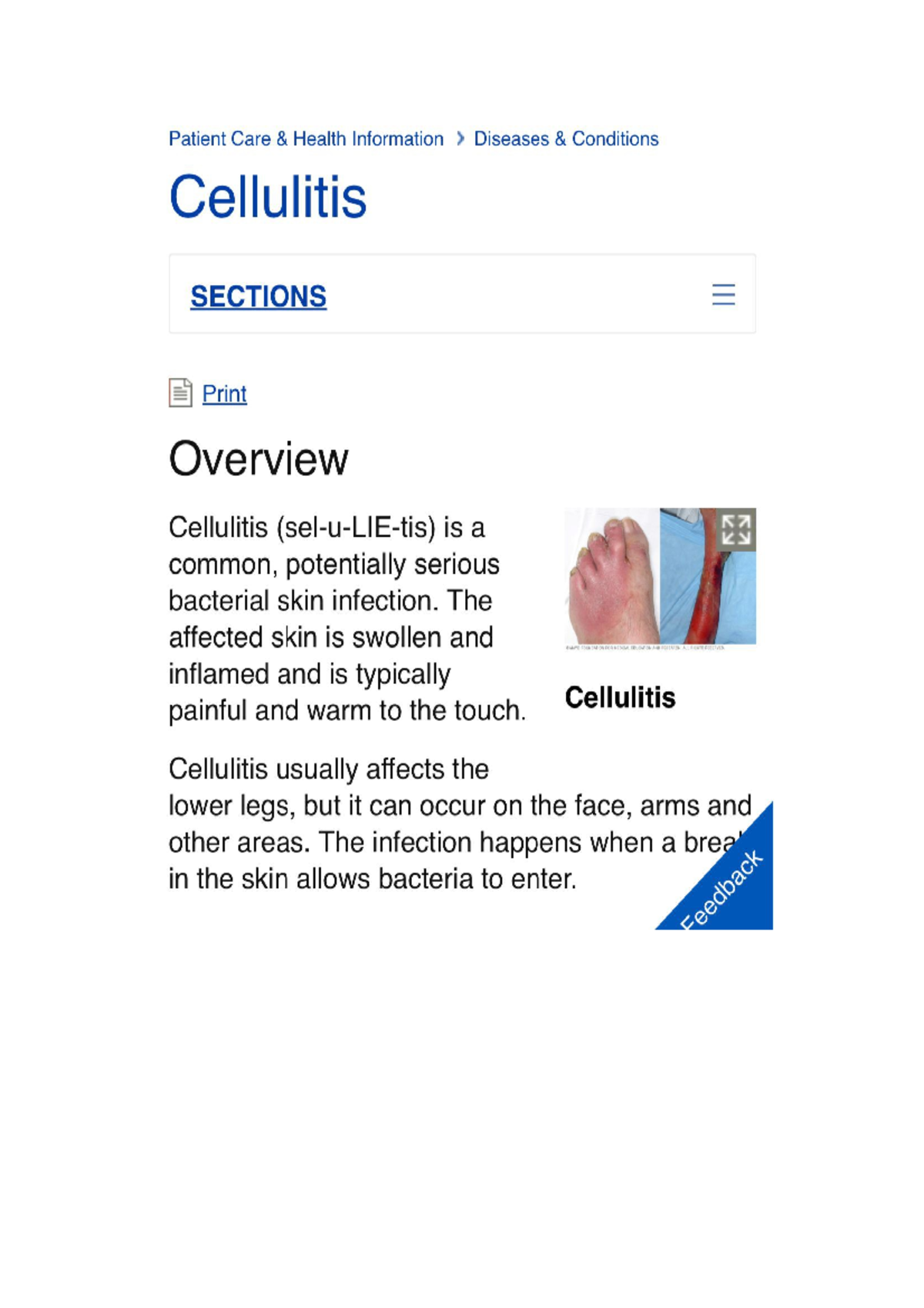 Cellulitis - Skin Infection or Skin swollening condition - Cardiac ...