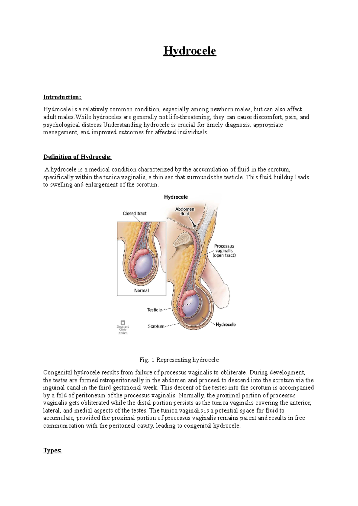 Hydrocele compilation - Hydrocele Introduction: Hydrocele is a ...