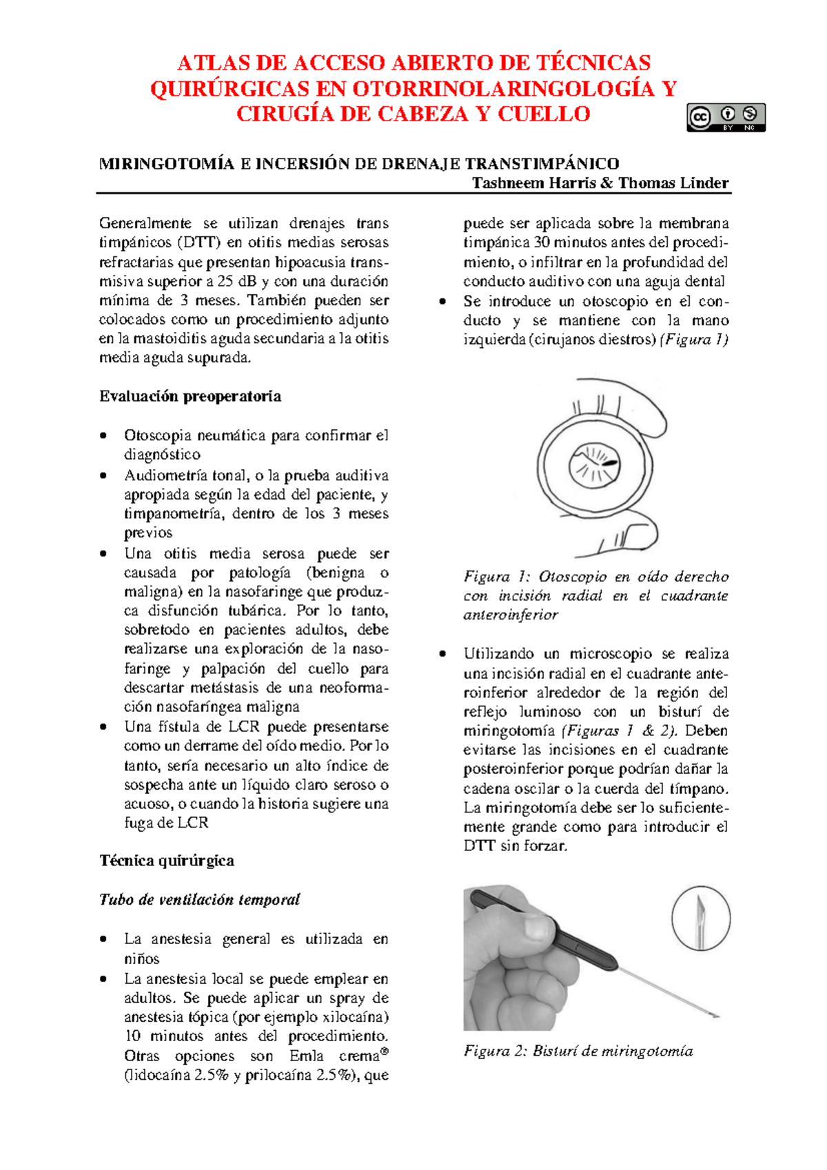 Miringotomía e incersión de drenaje transtimpánico - ATLAS DE ACCESO ...