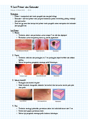 ORAL Squamous CELL Carcinoma-1 - ORAL SQUAMOUS CELL CARCINOMA menyerang daerah epitel squamosa ...