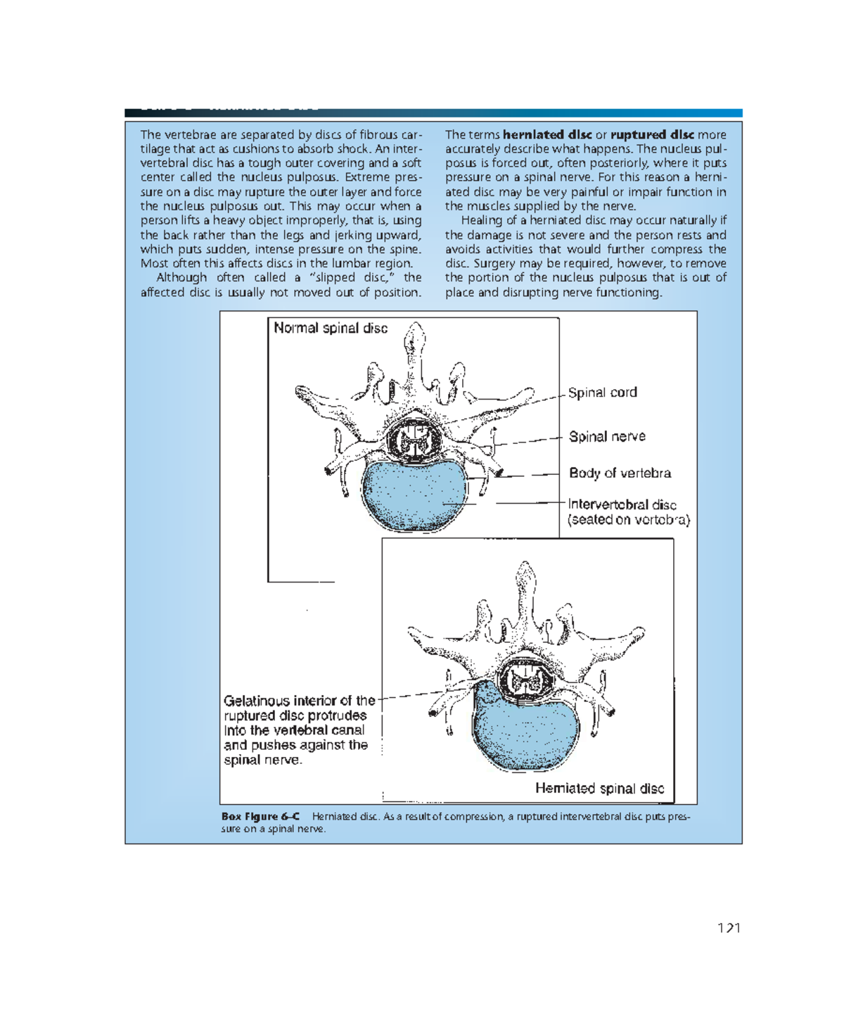 Biology - Health BODY 14 - BOX 6–3 HERNIATED DISC The vertebrae are ...
