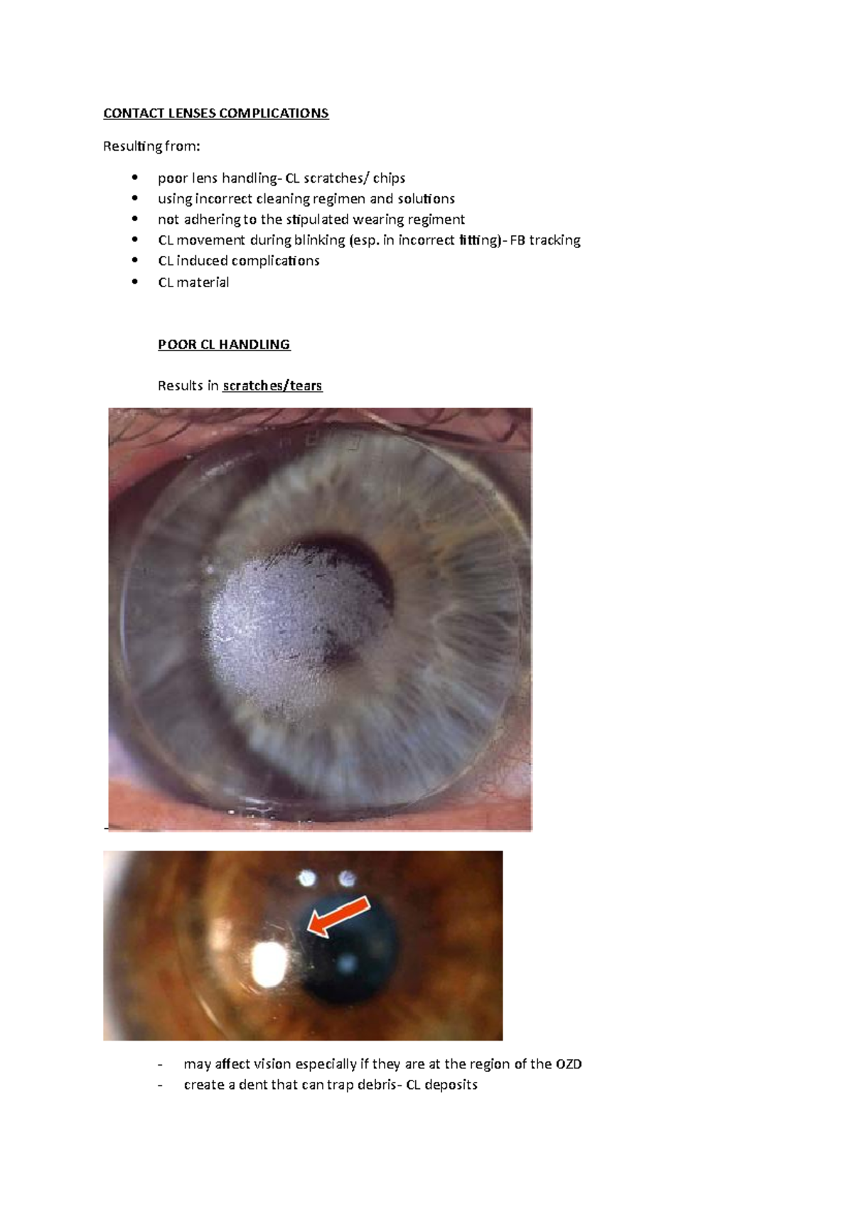 Contact Lenses Complications - CONTACT LENSES COMPLICATIONS Resulting from: poor lens handling ...