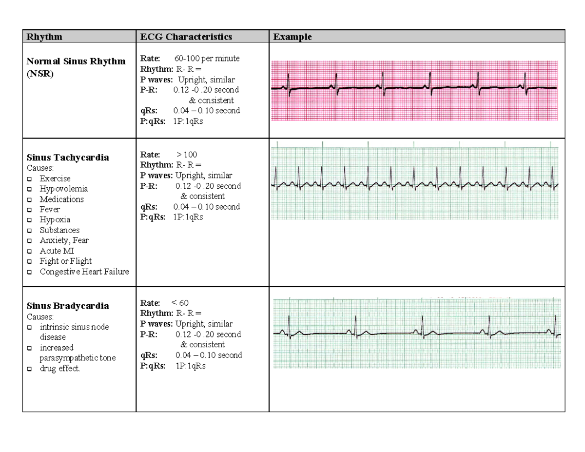 ECG Review: Rhythm and ECG Characteristics - Studocu