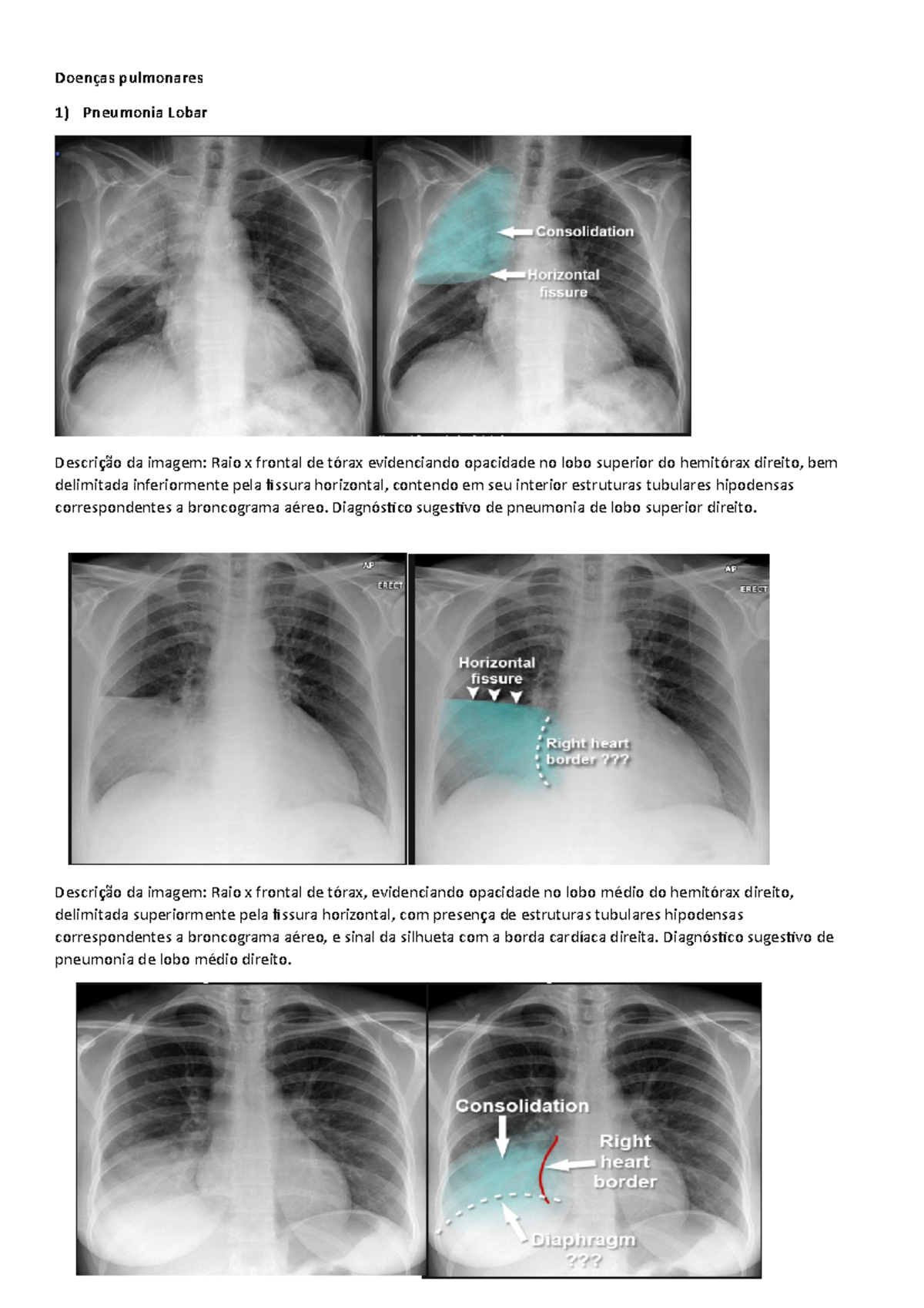 Torax radiologia - Doenças pulmonares 1) Pneumonia Lobar Descrição da ...