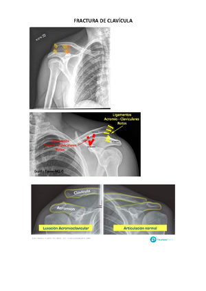 Criterios Light - Criterios de light. del derrame pleural CRITERIOS DE ...