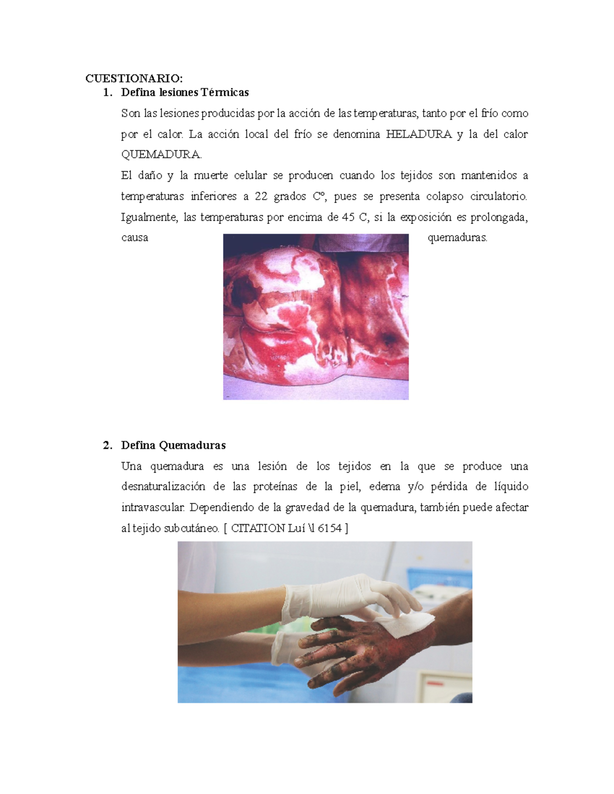 ATENCION DE ENFERMERIA EN LESIONES TÉRMICAS (QUEMADURAS) EN LA ...