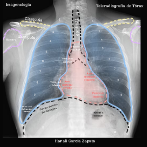 Act Signos Radiologicos - PICO DE PAJARO Trastorno que afecta la ...