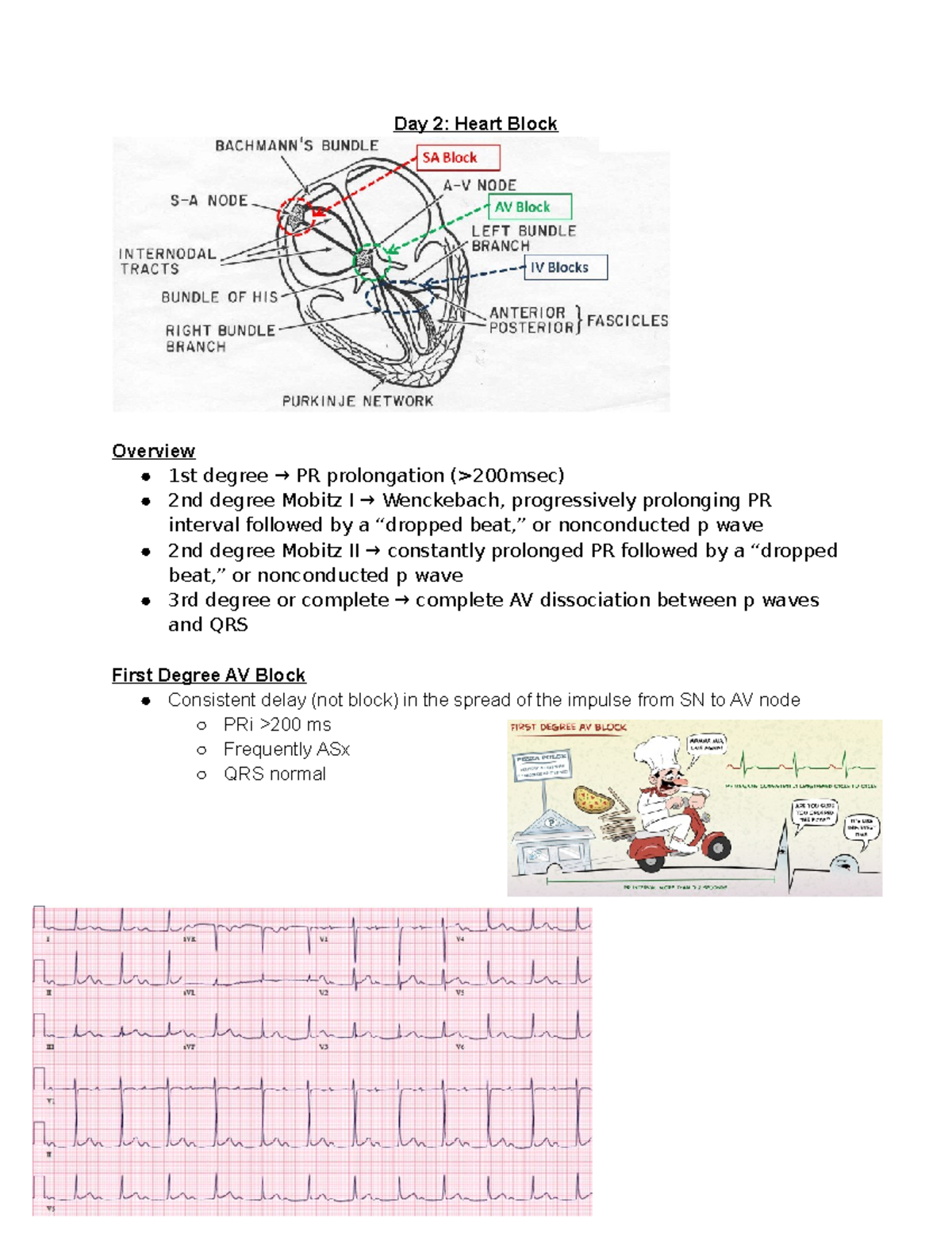 Heart Block Notes - Day 2: Heart Block Overview 1st degree → PR ...