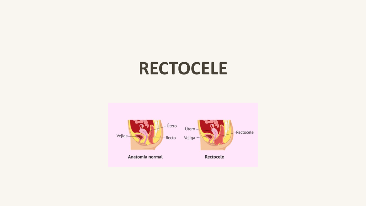 Rectocele - RECTOCELE ¿Qué es un rectocele? Un rectocele es un tipo de ...