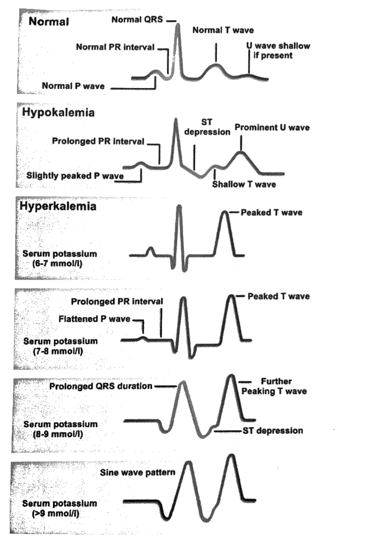 NR 324 EKG - K+ imbalances in ECG/EKG - Normal Normal QRS Normal T wave Normal PR interval ali U ...