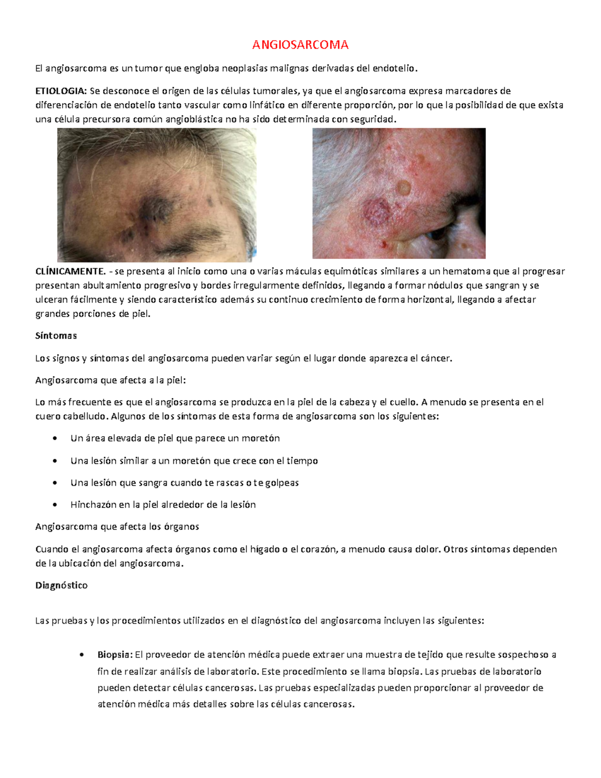 Angiosarcoma - exposicon - ANGIOSARCOMA El angiosarcoma es un tumor que ...