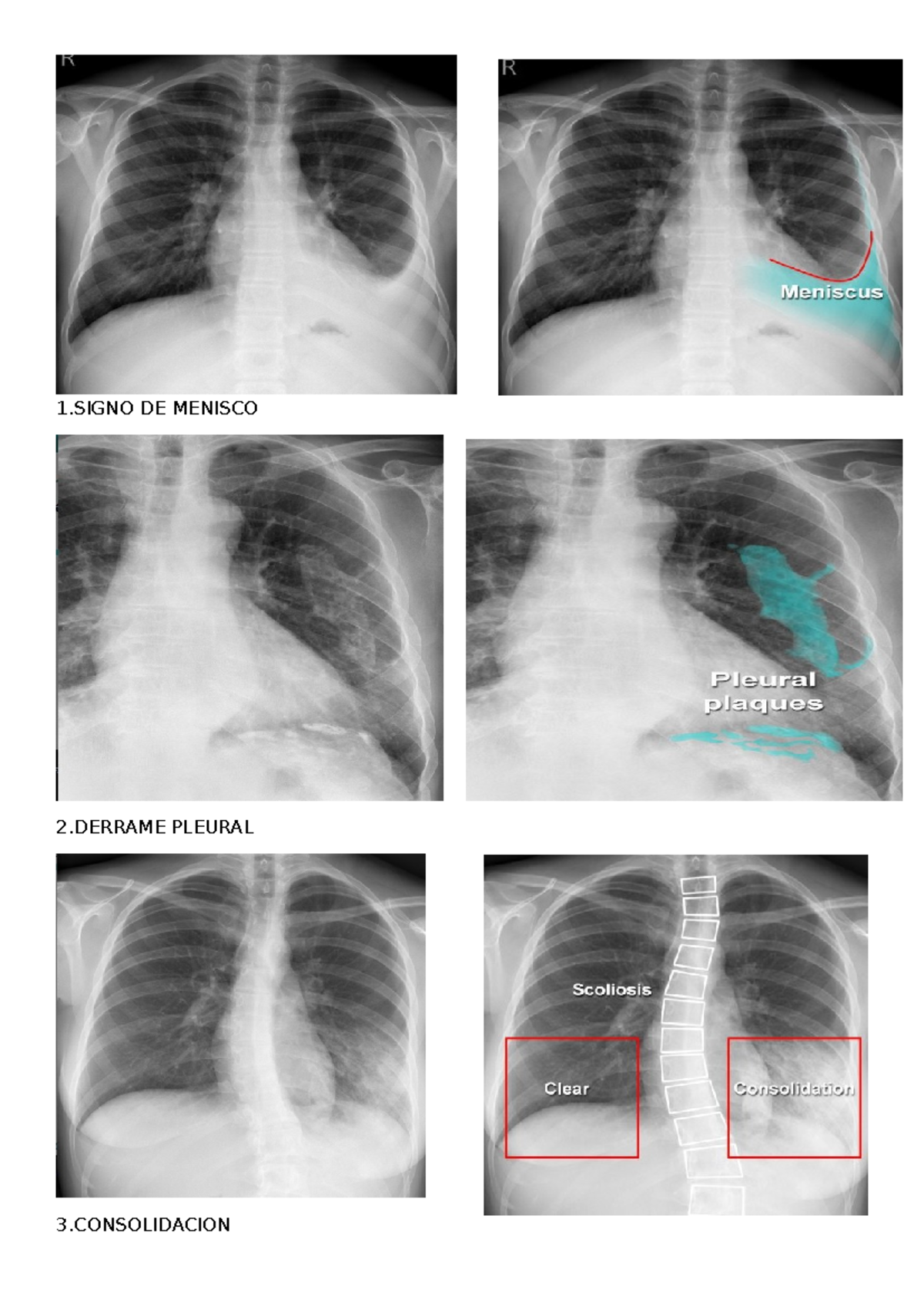 Rayosx - Radiologia - 1 DE MENISCO 2 PLEURAL 3 4 DE TORAX NORMAL 5 ...