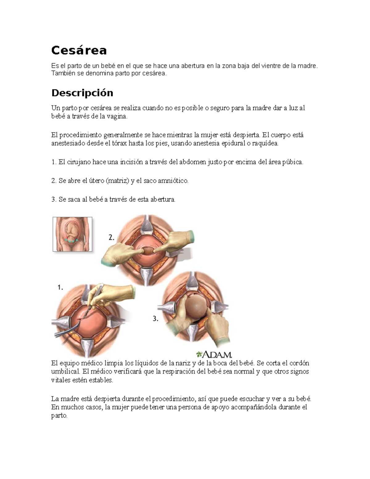 Cirugias - cirugia - Cesárea Es el parto de un bebé en el que se hace ...