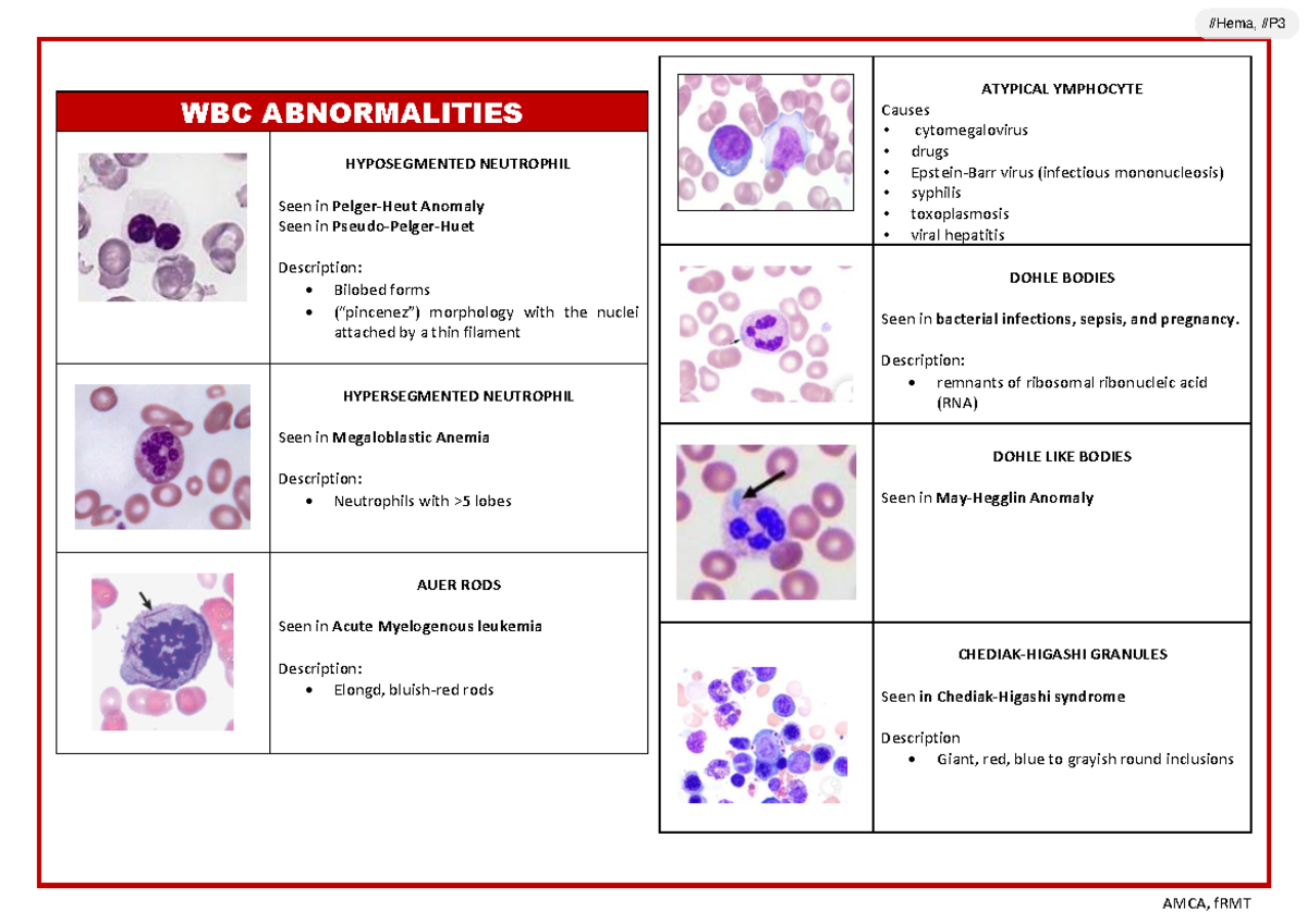 Hematology - WBC ABNORMALITIES HYPOSEGMENTED NEUTROPHIL Seen in Pelger ...