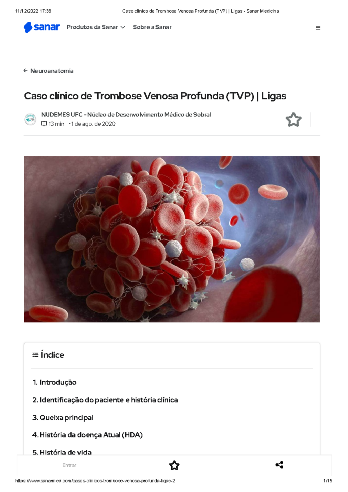 Caso clínico de Trombose Venosa Profunda (TVP) Ligas - Sanar Medicina ...