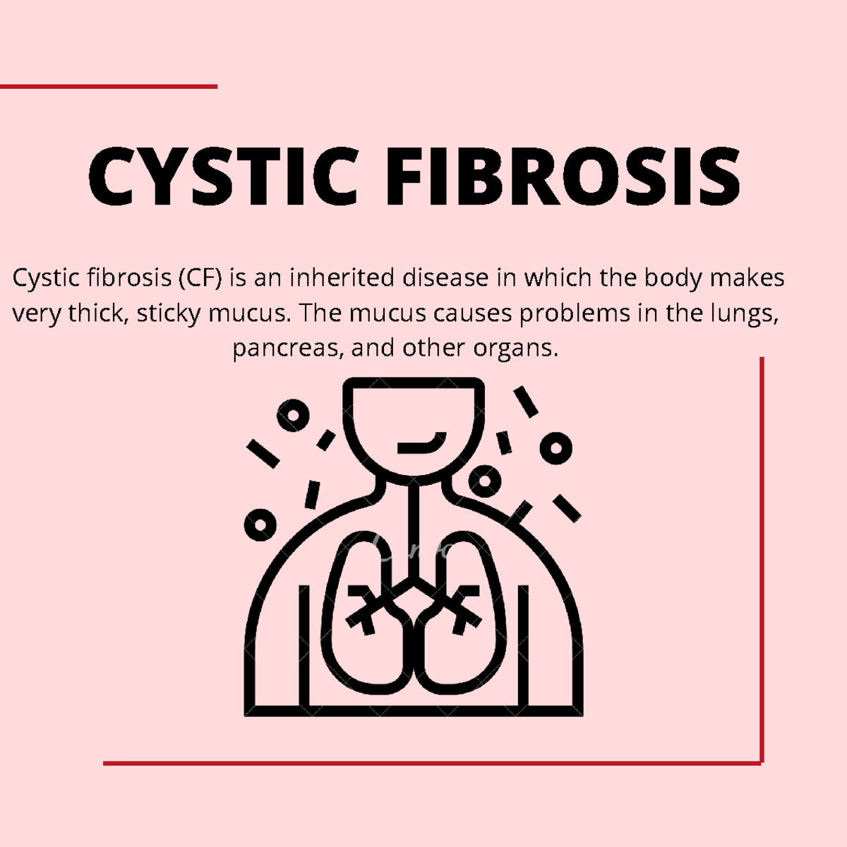 Cystic fib flyer - cyst fibrosis work - N340 - CYSTIC FIBROSIS Cystic ...