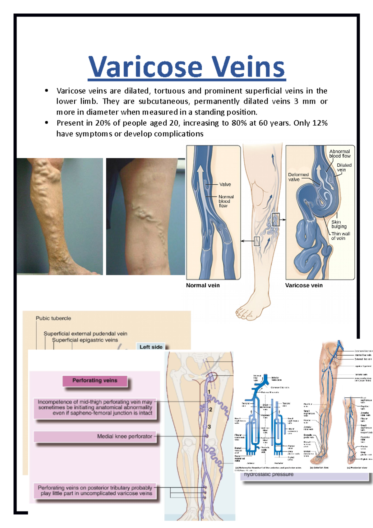 Varicose Veins - Varicose Veins Varicose veins are dilated, tortuous ...