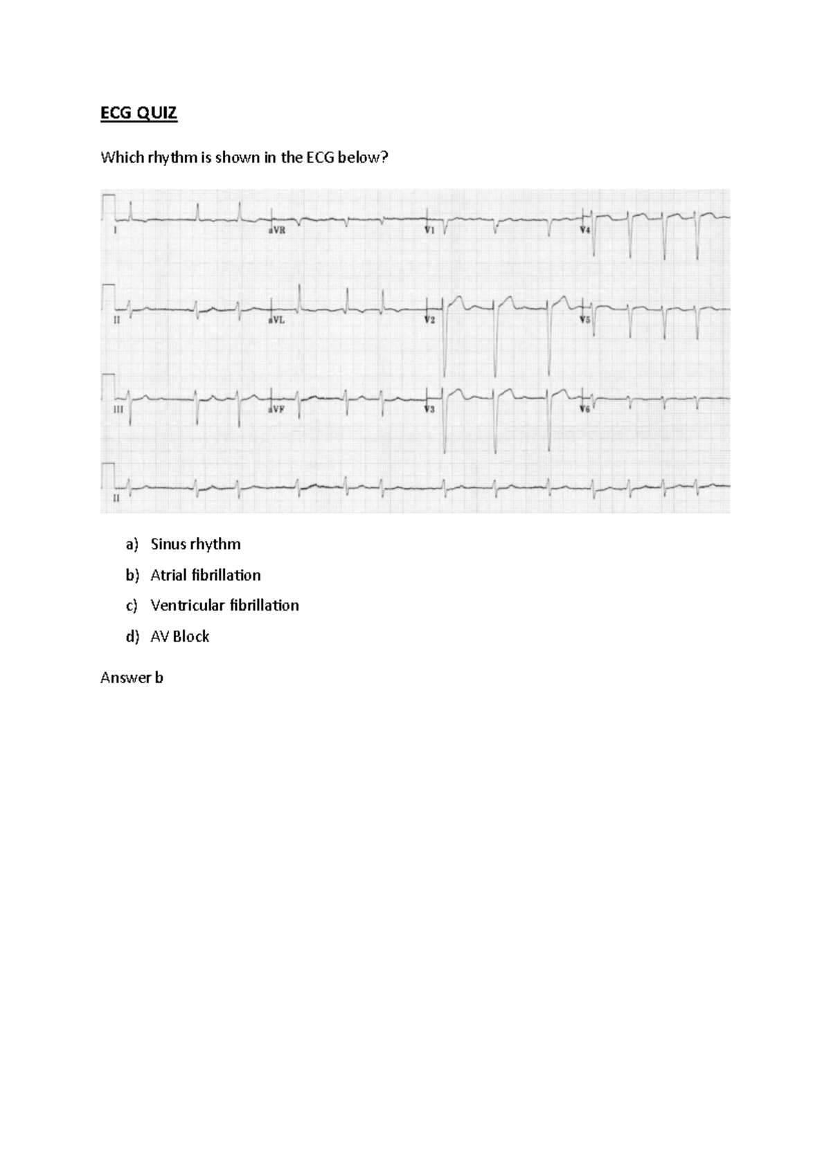 ECG quiz - ecq quiz - ECG QUIZ Which rhythm is shown in the ECG below ...