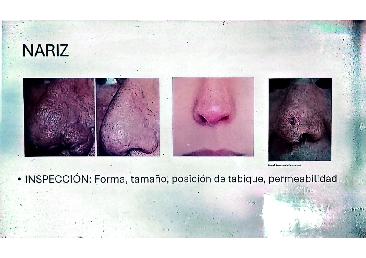 Nariz - namnesis - NARIZ INSPECCIÓN: Forma, tamaño, posición de tabique ...